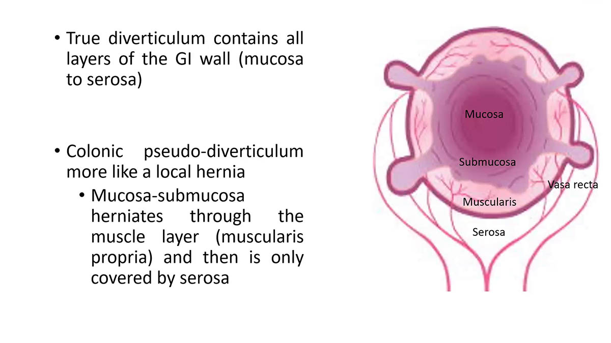 Diverticular disease explained - Red Trouser Day (RTD)